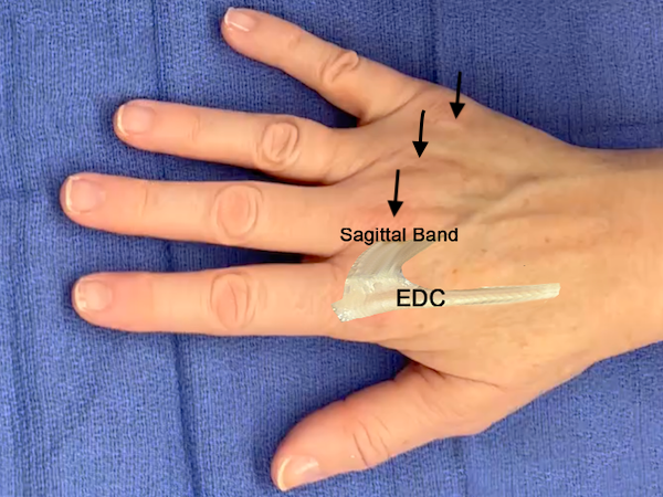 Sagittal Band Exam | Anatomic Structures at Risk
